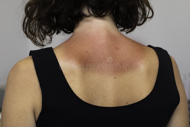 Girl With Sunburned Back Redness In The Areas Of Skin Uncovered By The