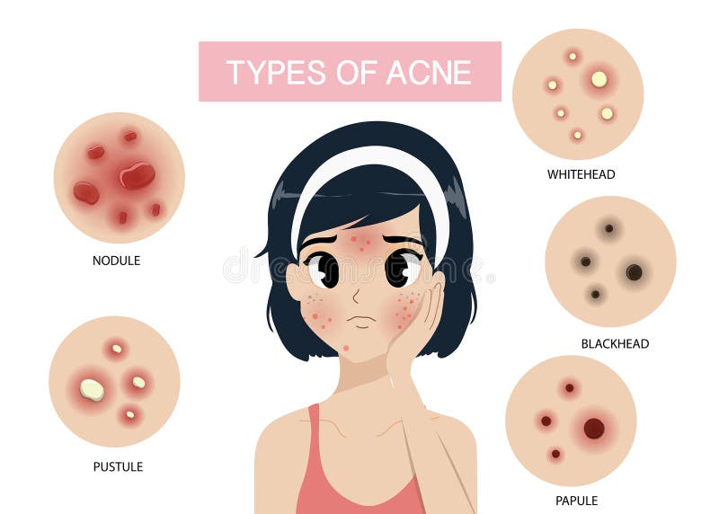 Types Of Acne Pimples Stock Vector Illustration Of Care 49622589