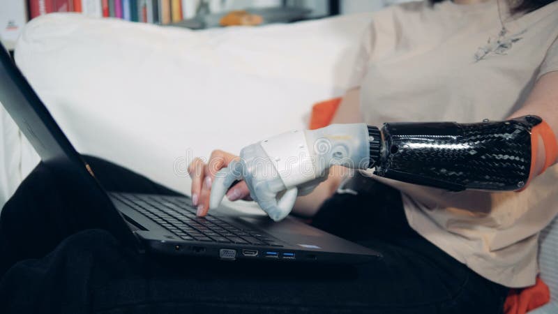 Girl is Typing on a Laptop with a Prosthetic Arm Stock Video - Video of ...