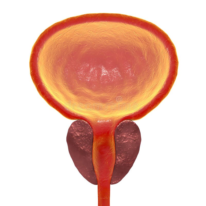 Próstata Normal E Prostatite Aguda Ilustração Médica Ilustração do ...