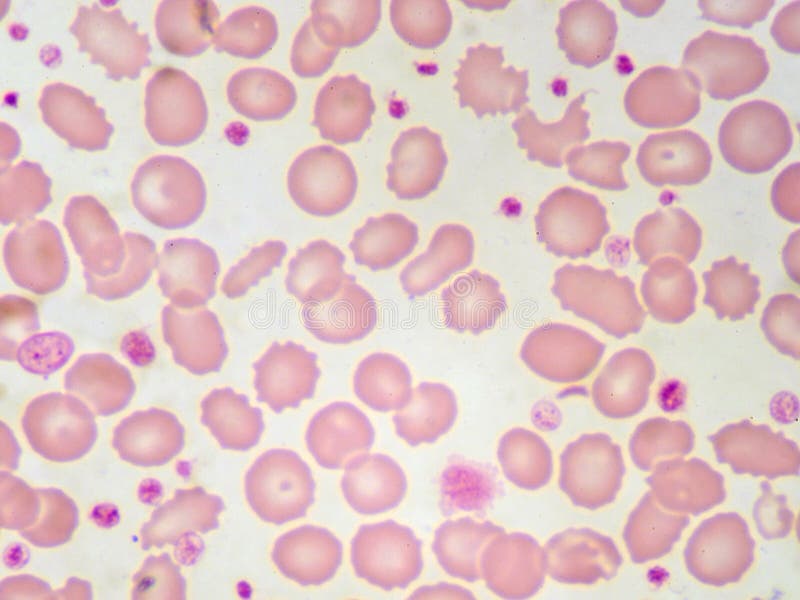 Glóbulos rojos foto de archivo. Imagen de anemia, microscopio - 100135432