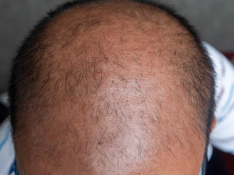 Glabrous on Male Bald Head . Stock Image - Image of hairline, male ...