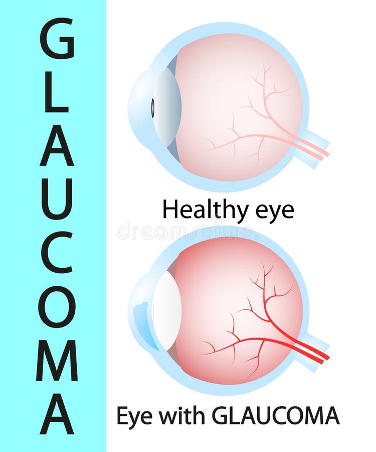 Healthy Eye, Glaucoma, Cataract. Eye Deseases. Isolated on White. 3D ...