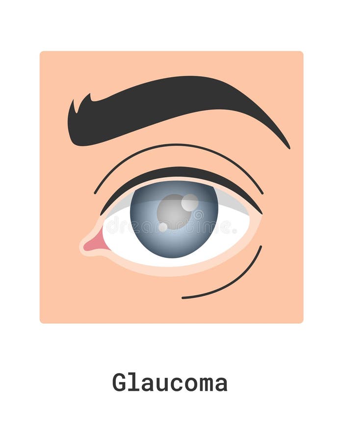 Glaucoma. Human Eye. Vector Illustration. Stock Vector - Illustration ...