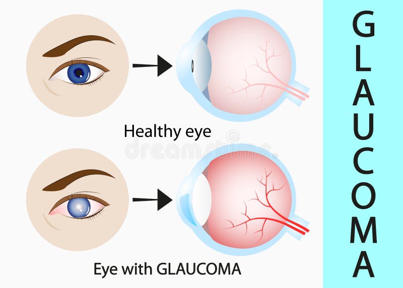 Glaucome Symptômes Du Glaucome Atrophie Du Nerf Optique Champ Visuel Au ...