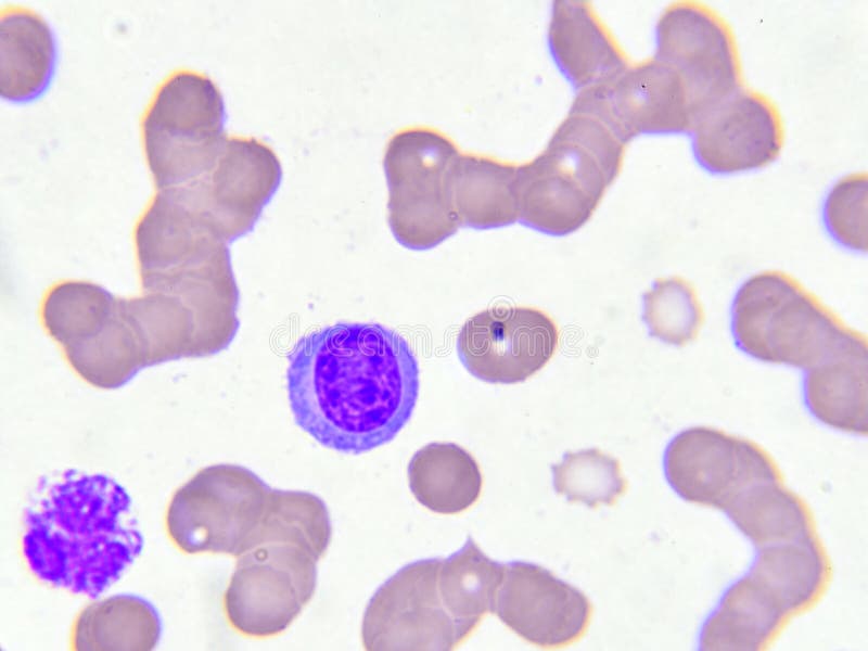 Globuli Bianchi in Striscio Di Sangue Fotografia Stock - Immagine di ...