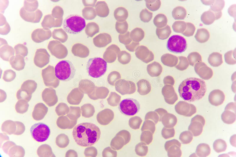 Globuli Bianchi in Striscio Di Sangue Immagine Stock - Immagine di ...
