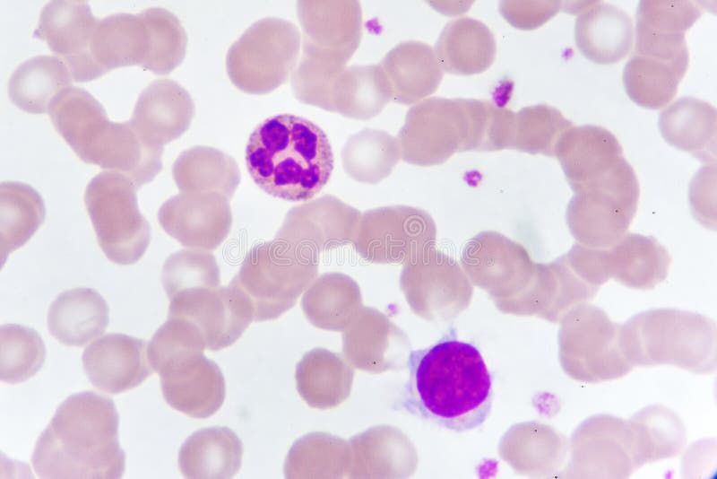 Globuli Bianchi in Striscio Di Sangue Immagine Stock - Immagine di ...