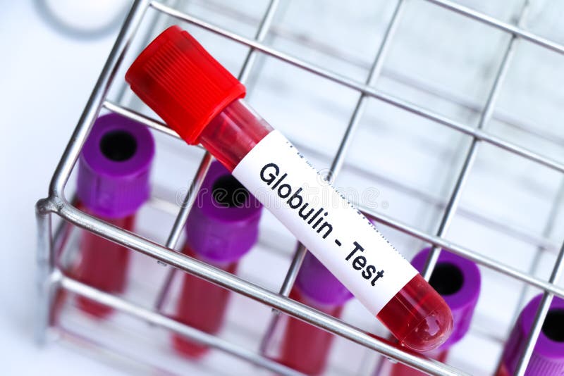 Globulin Test To Look for Abnormalities from Blood Stock Photo - Image ...
