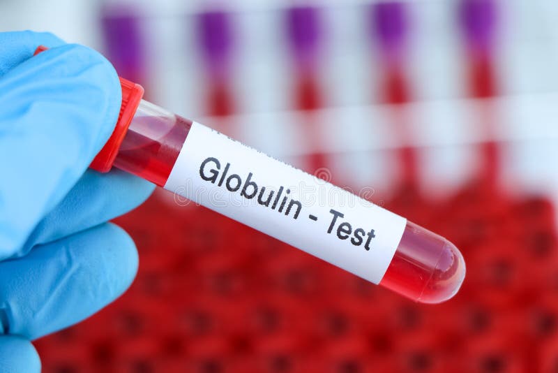 Globulin Test To Look for Abnormalities from Blood Stock Photo - Image ...