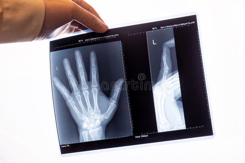 A Gloved Hand Holds Up a Digital X-ray Image of a Hand Showing Two ...