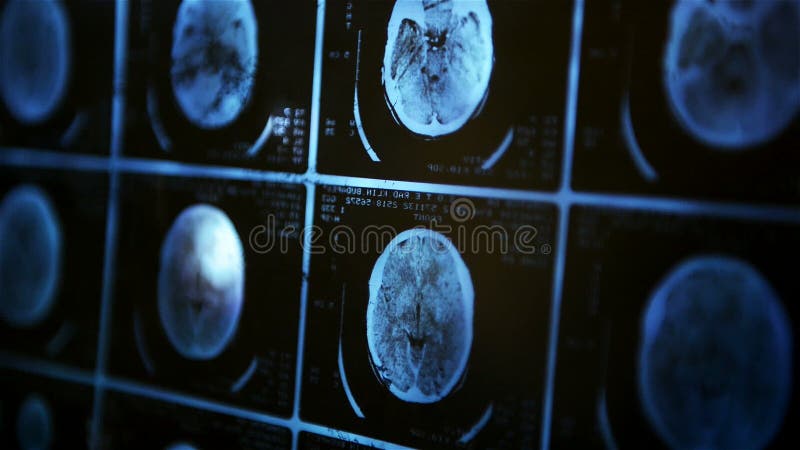 Glowing and Radiant MRI Scan Stock Footage - Video of cancer, black ...