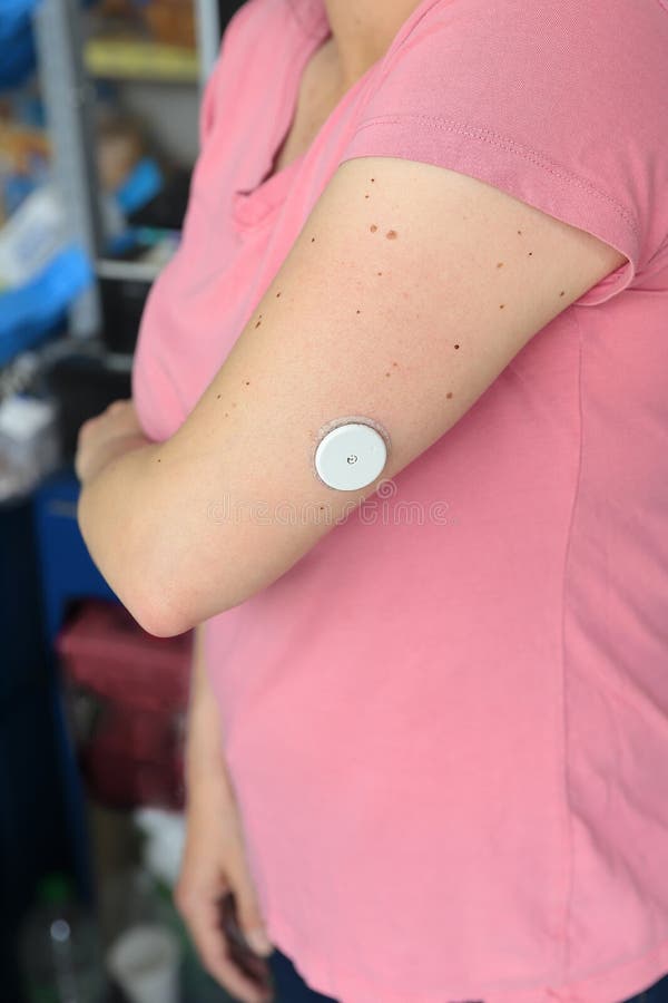 Glucose Sensor Implanted in the Arm of a Working Woman Stock Photo ...