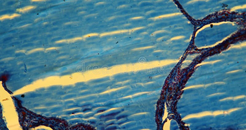 Goiter Colloid Goiter Tissue Stock Video - Video of glands, colloid ...