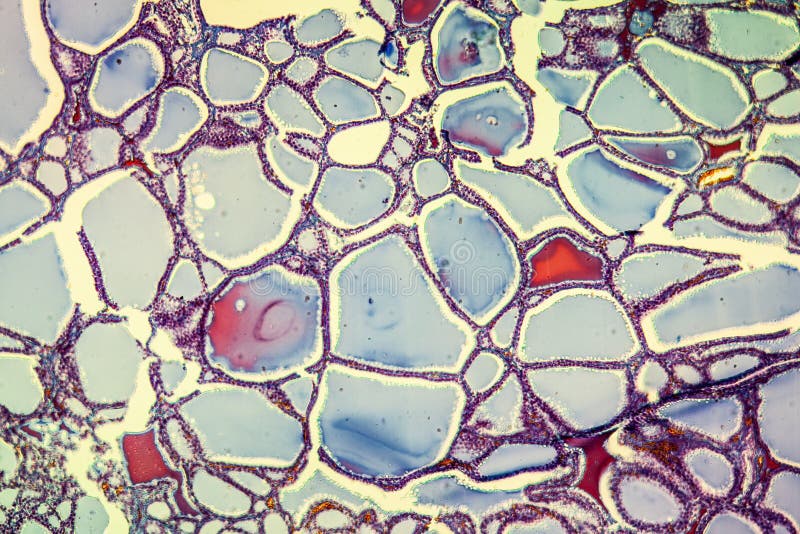 Goiter with Colloid Thyroid Disease Stock Photo - Image of pathology ...