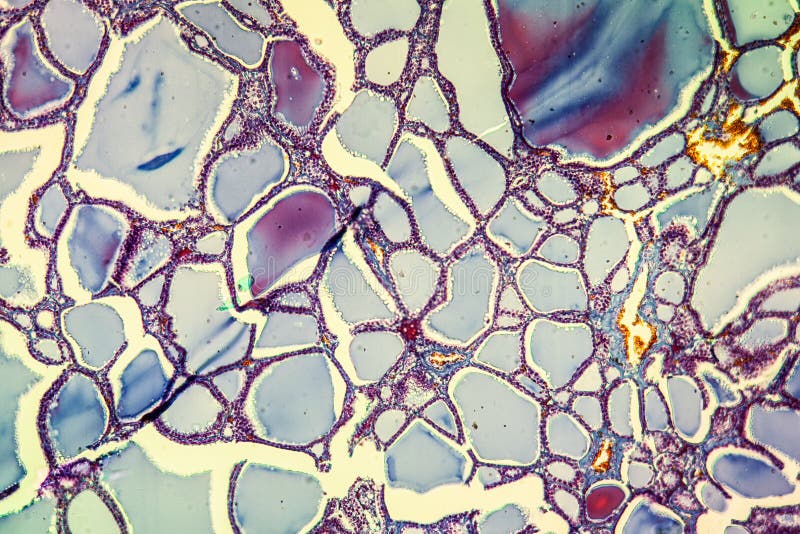 Goiter with Colloid Thyroid Disease Stock Photo - Image of pathology ...