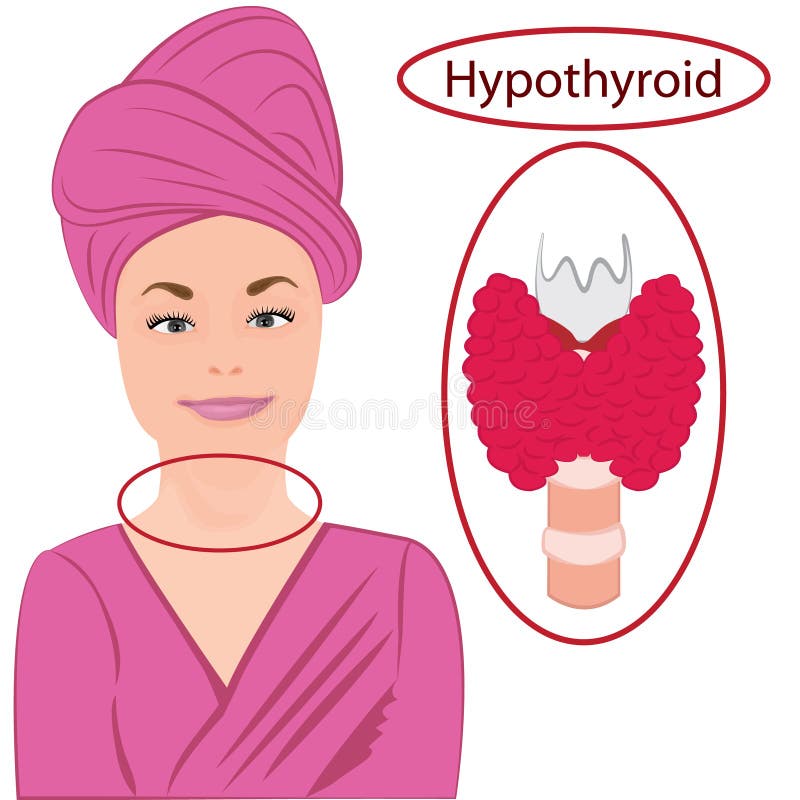Thyroid. Endocrine Gland. Illness of the Endocrine System Stock Vector ...
