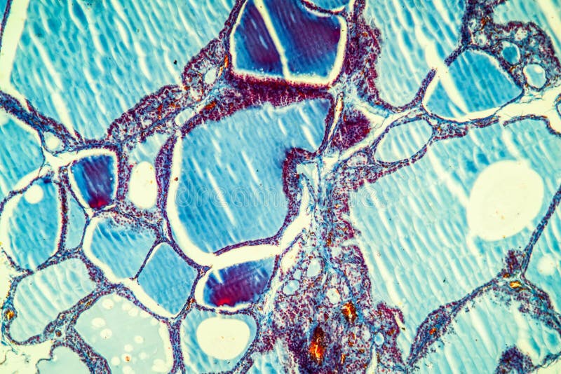 Goiter with Colloid Thyroid Disease Stock Image - Image of thin ...