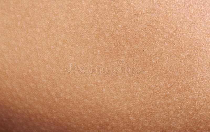 Goosebumps Skin Disease