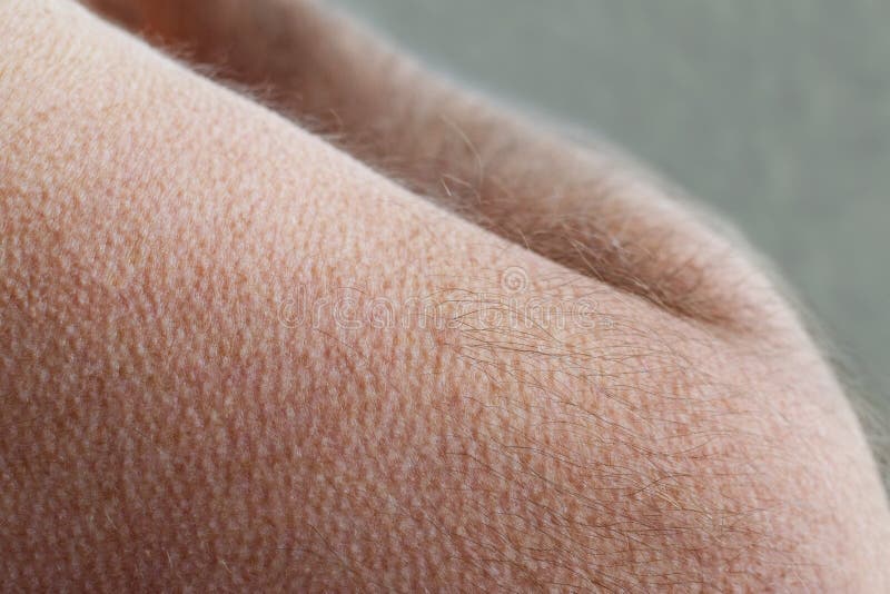 Cold Bumps In Arm Common Causes Of Bumps On Elbows (With Pictures)