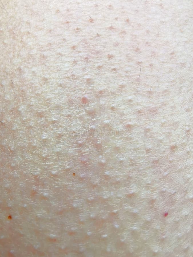 Goosebumps Skin Disease