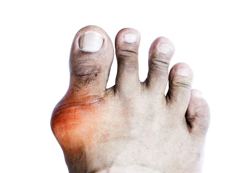 1,285 Gout Rheumatoid Stock Photos - Free & Royalty-Free Stock Photos ...