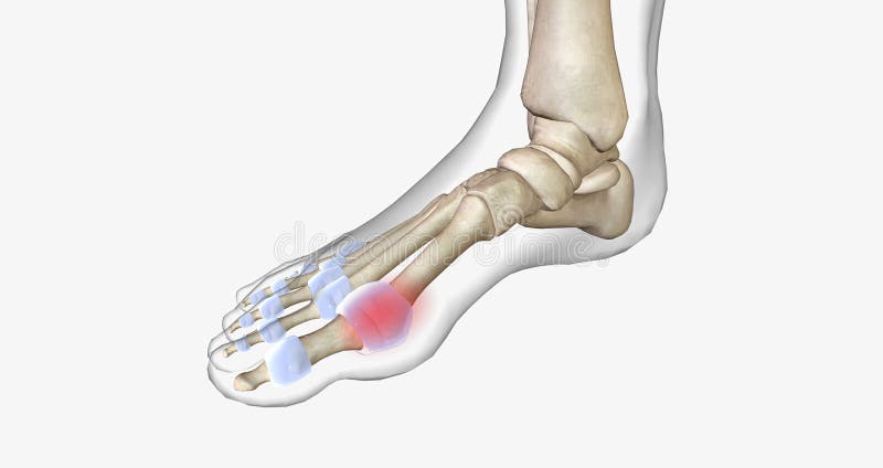 Gout is a Common Type of Inflammatory Arthritis, a Disease in Which the ...