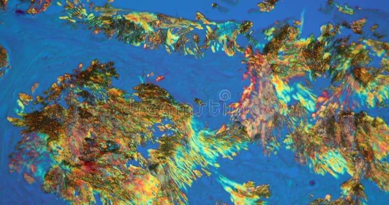 Gout crystals in tissue stock video. Video of anatomy - 196611791