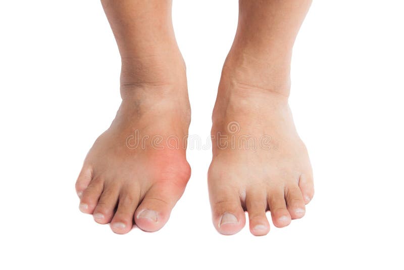Gout Inflammation on the Right Foot Stock Photo - Image of healthcare ...
