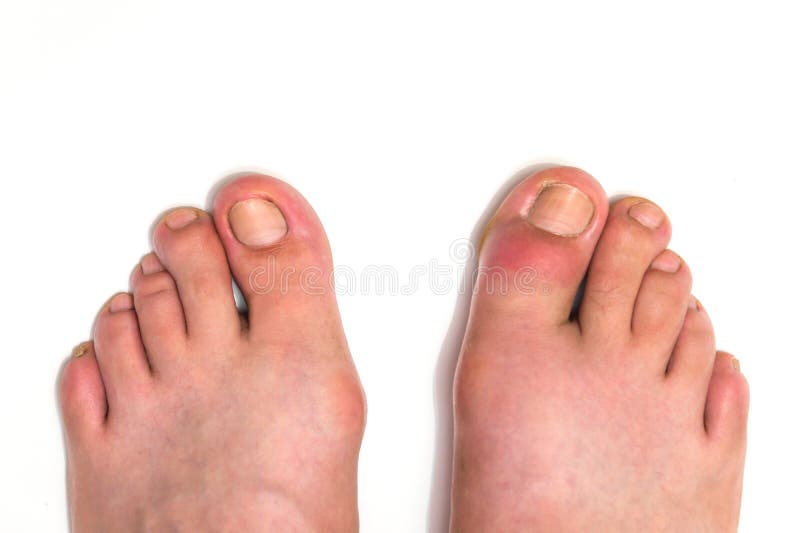 Smaller Gout In Toes