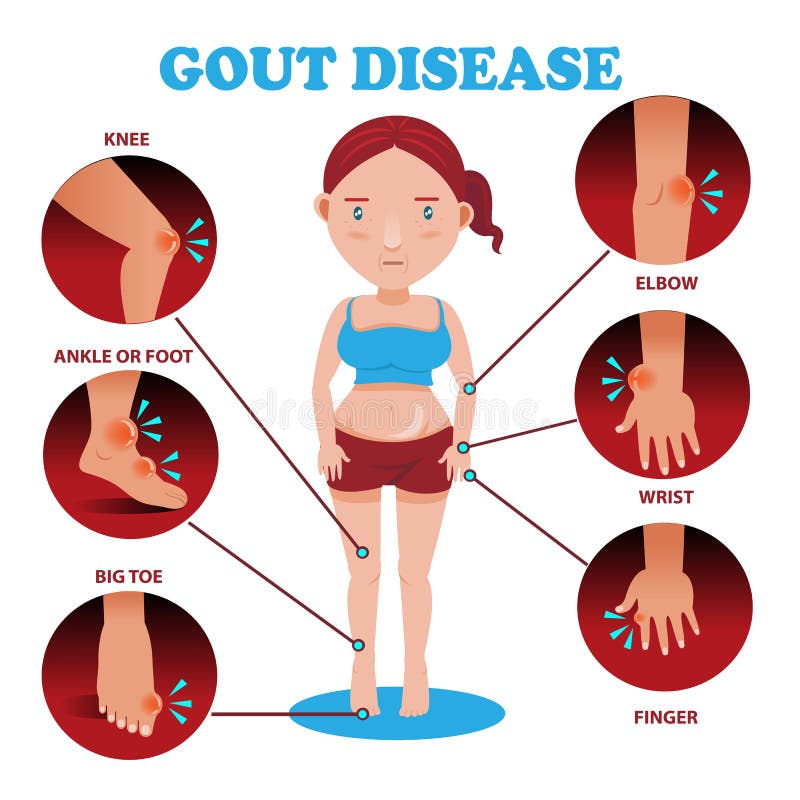 Gout Medical Stock Illustrations – 788 Gout Medical Stock Illustrations ...