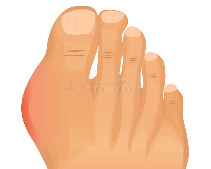 Gout vector illustration. stock vector. Illustration of health - 88094515