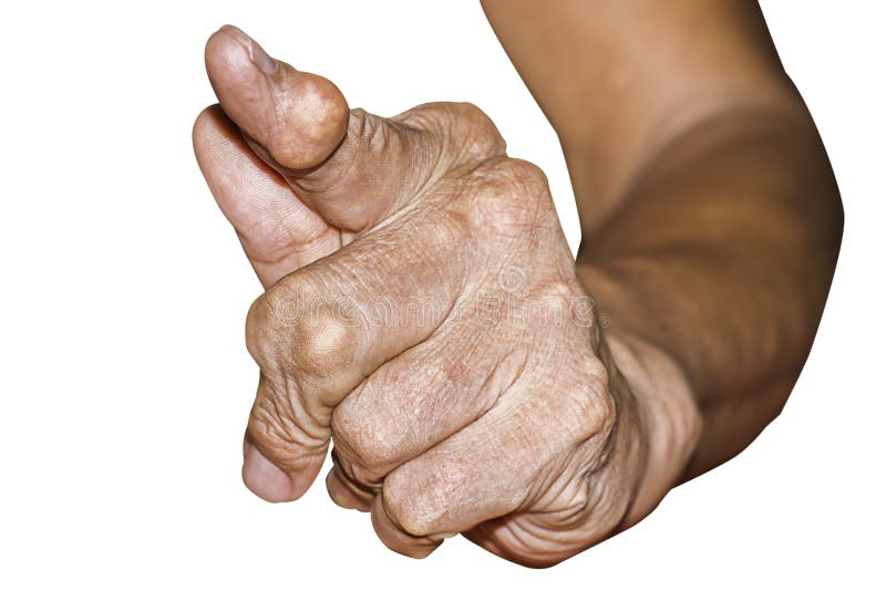 Goutte Sévère Chez Les Hommes Souffrant De Douleurs Articulaires ... Goutte Sévère Chez Les Hommes Souffrant De Douleurs Articulaires ...