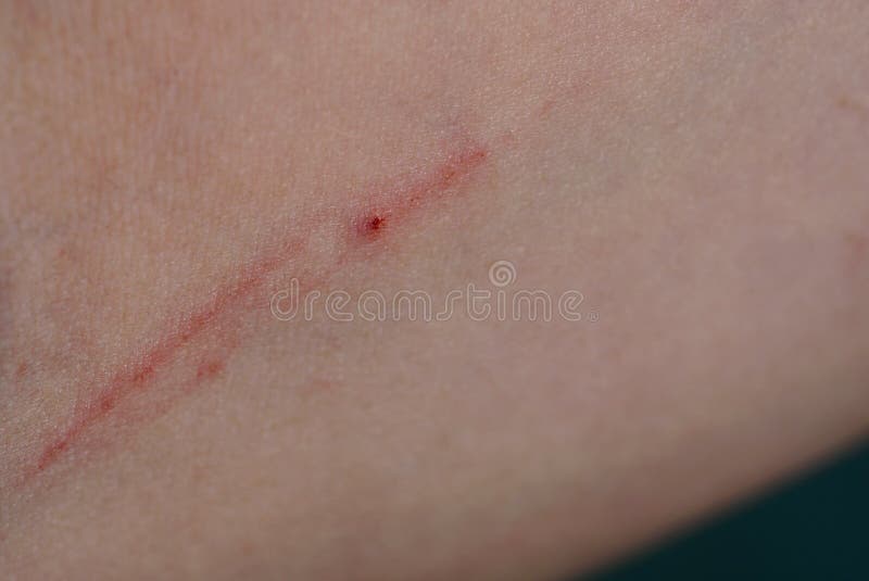 Pelle, Ferita O Taglio Del Graffio Sulla Pelle, Rosso Sangue Parte ...