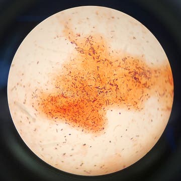 Gram Stain of E. Coli and S. Aureus Under Microscope Stock Photo ...