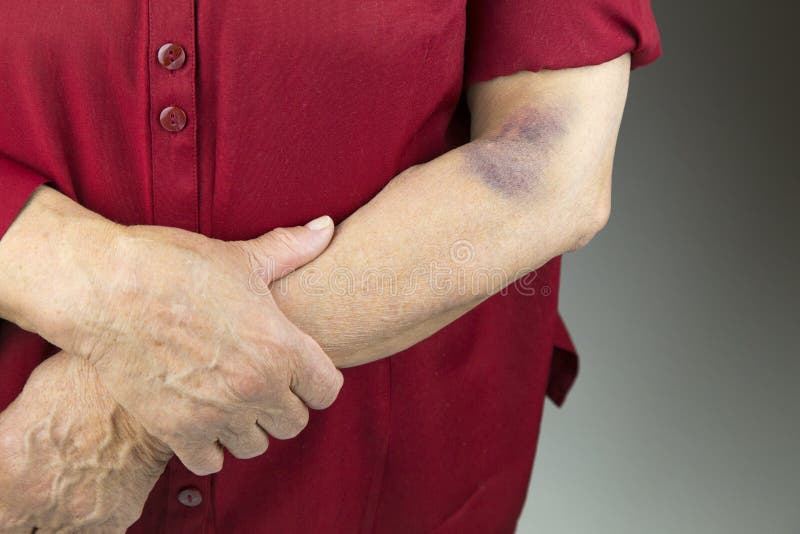 Grande Contusion Sur Le Bras Humain Image stock - Image du blessures ...