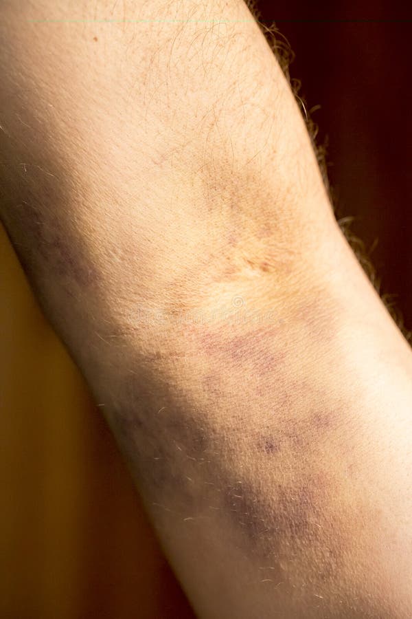 Grande Contusion Sur Le Bras Humain Image stock - Image du blessures ...