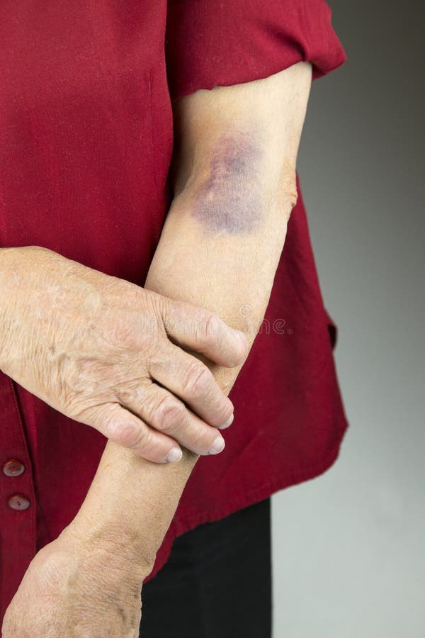 Grande Contusion Sur Le Bras Humain Image stock - Image du blessures ...