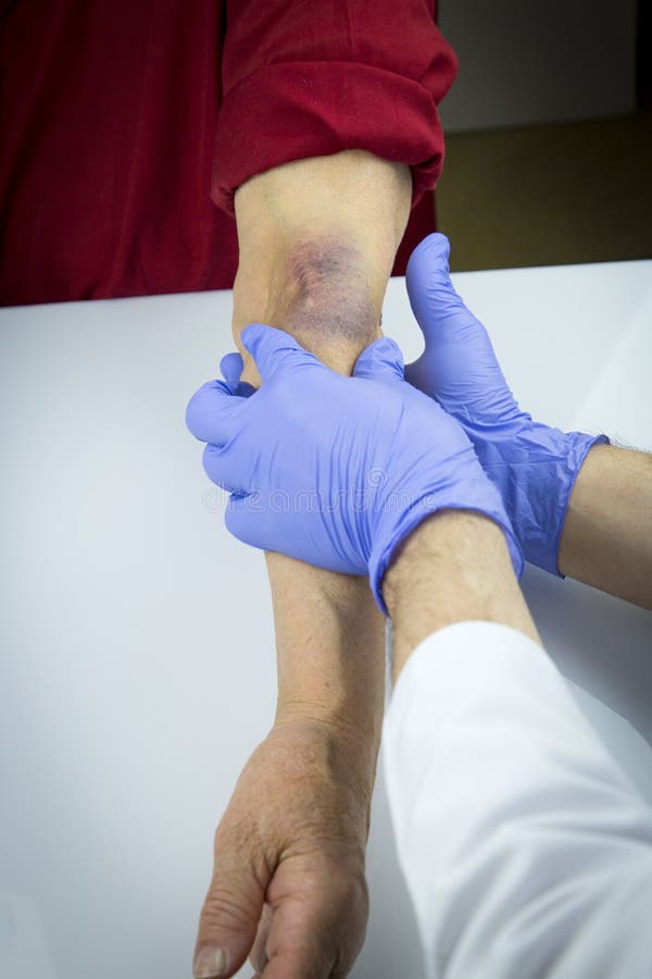 Grande Contusion Sur Le Bras Humain Image stock - Image du blessures ...