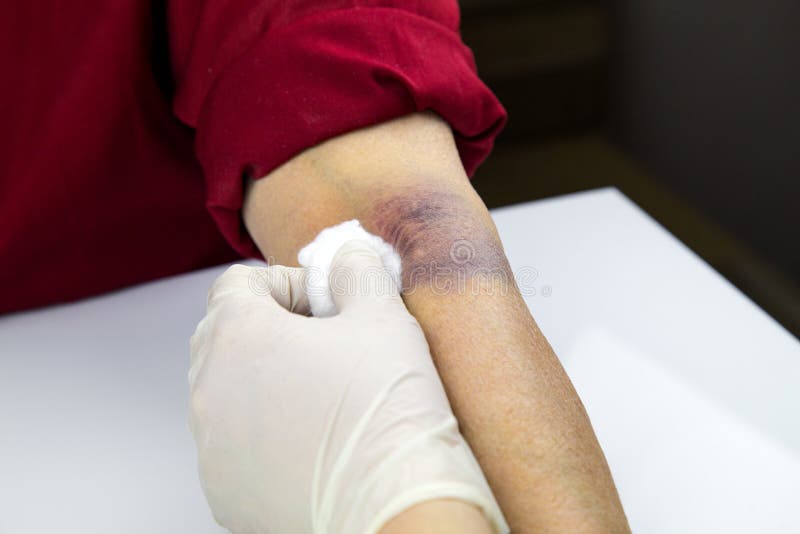 Braccio Con Le Contusioni Dell'iniezione Ed Il Wristband Dell'ospedale ...