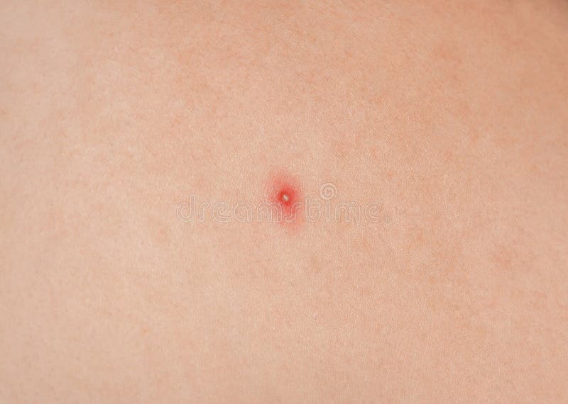 Pustules Et Vésicules Rouges Sur La Peau De La Main Comme Symptômes De ...