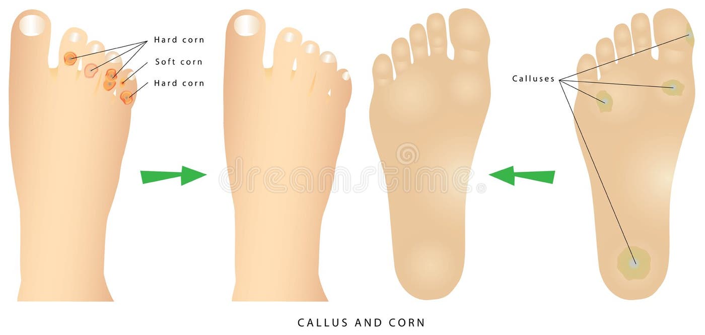 Callos Ilustraciones Stock, Vectores, Y Clipart – (112 Ilustraciones Stock)