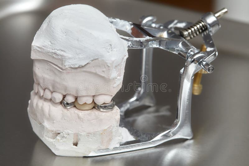 Gray Dental Prosthesis Teeth Mold, Clay Human Gums Model Stock Photo ...