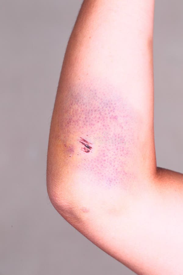 Grote Bloeduitstorting Op De Menselijke Arm Stock Afbeelding - Image of ...