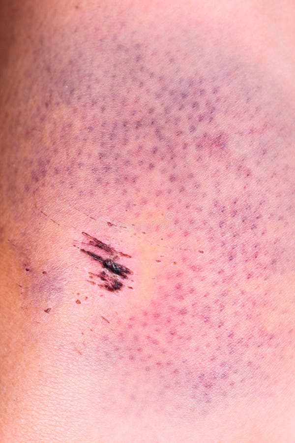 Groot Hematoom Op Menselijk Wapen Stock Foto - Image of elleboog ...