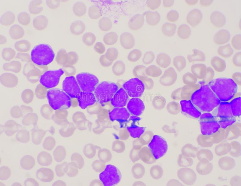 Blast Cells in Blood Smear. Stock Photo - Image of basophil, abnormal ...