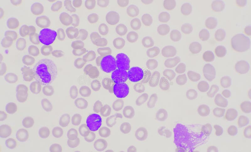 Leukemic Cells stock image. Image of body, human, anca - 23787991
