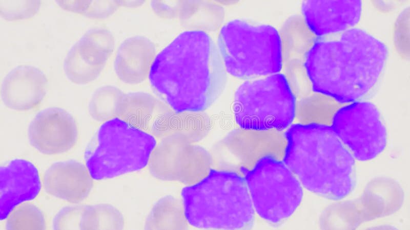 Leukemic Cells stock image. Image of body, human, anca - 23787991