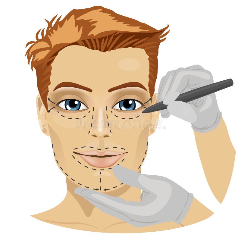 Guide Lines for Surgical Incisions on a Patient Male Face Stock Vector ...
