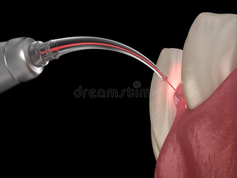 Gum Correction Surgery with Laser. Medically Accurate Tooth 3D ...